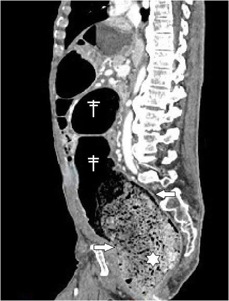 Colitis estercorácea como complicación del estreñimiento crónico ...