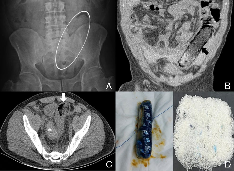 Body packer | Medicina Clínica