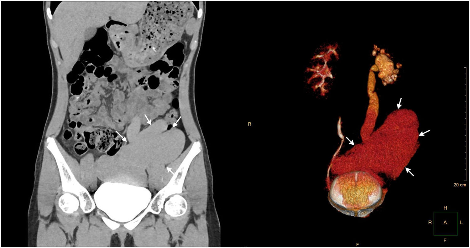 Congenital megaureter | Medicina Clínica