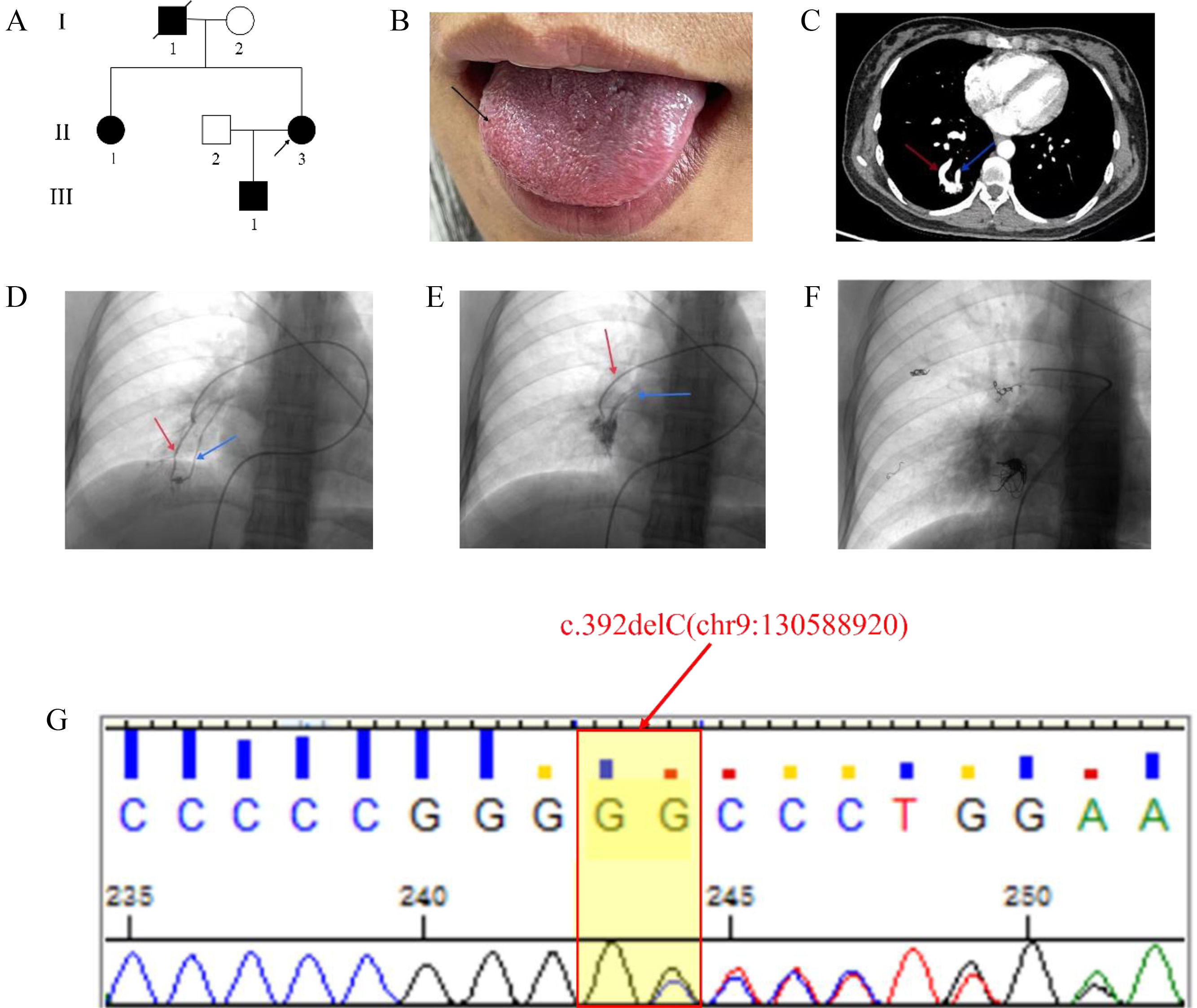 Genetic analysis of a family with hereditary hemorrhagic telangiectasia ...