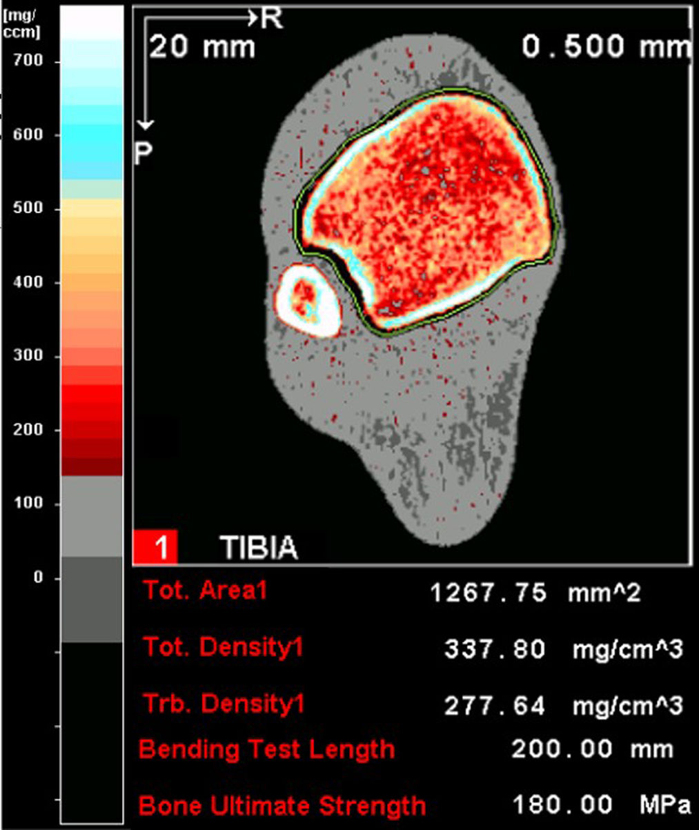 Characterization of bone disease in cystic fibrosis | Medicina Clínica