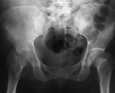 Musculoesquelético. Piomiositis: hallazgos radiológicos | Radiología