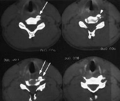 Elongación del tubérculo anterior de la apófisis transversa cervical ...