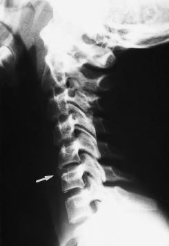 Elongación del tubérculo anterior de la apófisis transversa cervical ...