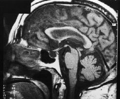 Silla turca vacía asociada a disfunción hormonal en adultos | Radiología