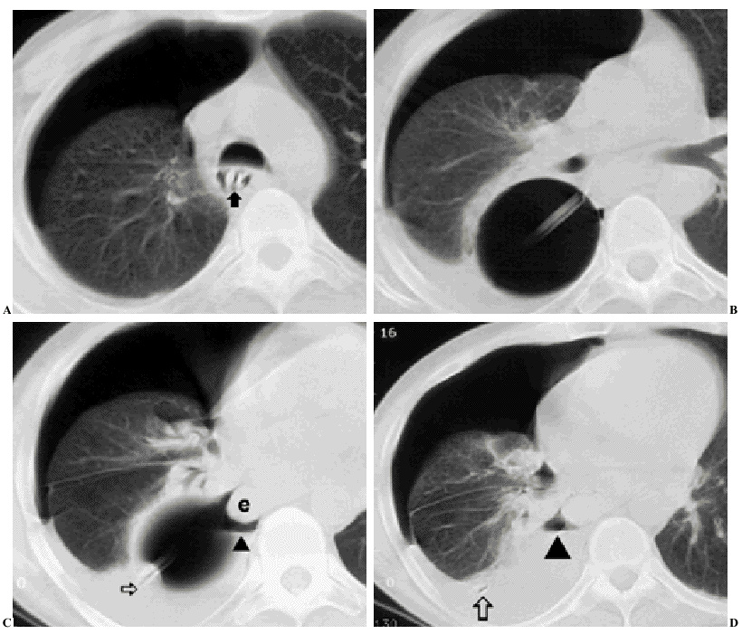 Perforación esofágica tras instrumentación con sonda de Sengstaken ...