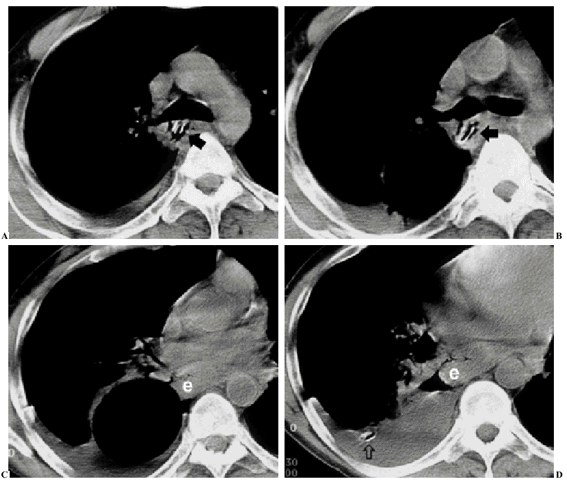 Perforación esofágica tras instrumentación con sonda de Sengstaken ...