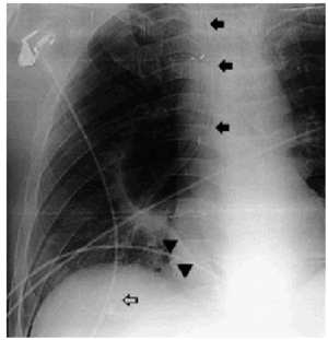 Perforación esofágica tras instrumentación con sonda de Sengstaken ...