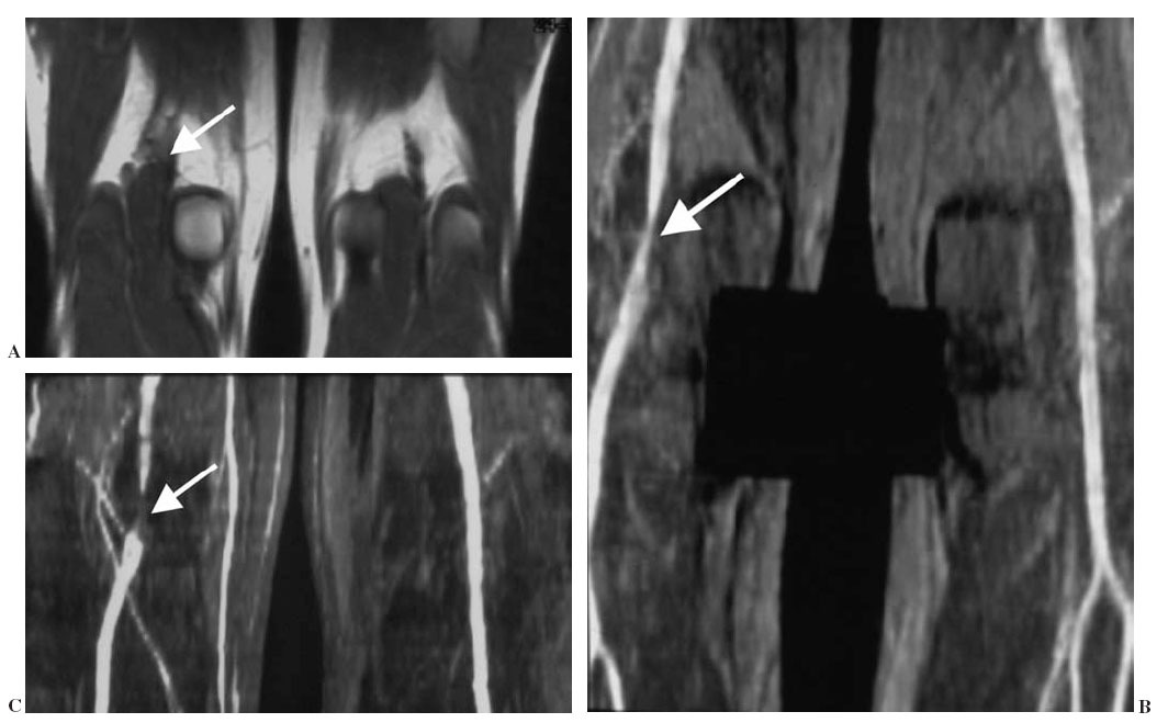 Angio-RM en el sistema osteomuscular | Radiología
