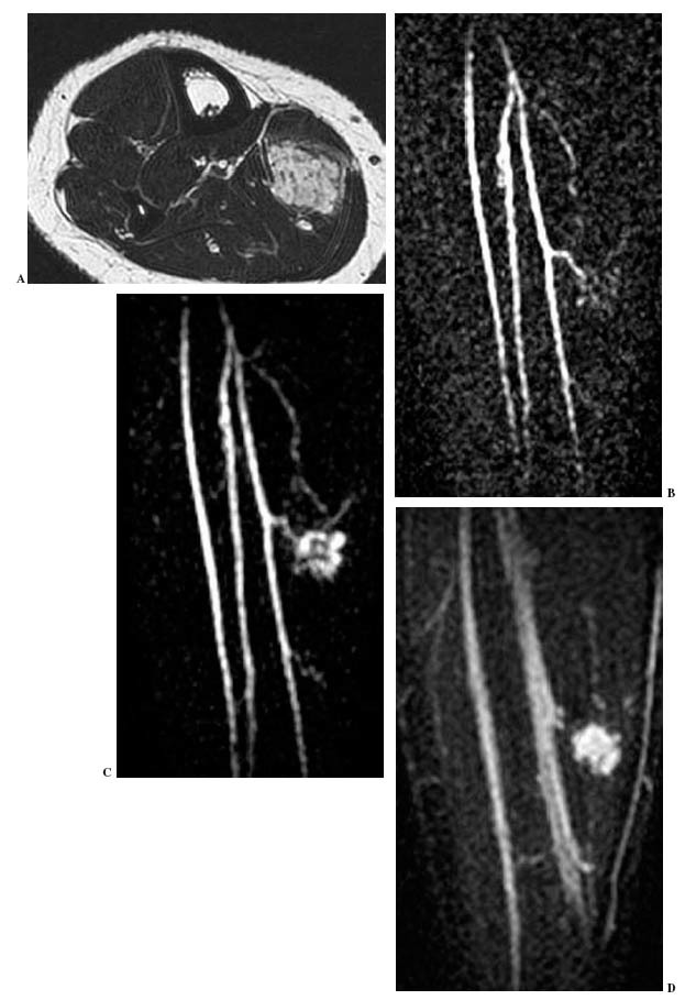 Angio-RM en el sistema osteomuscular | Radiología