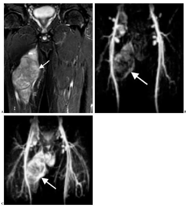 Angio-RM en el sistema osteomuscular | Radiología