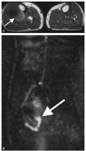 Angio-RM en el sistema osteomuscular | Radiología