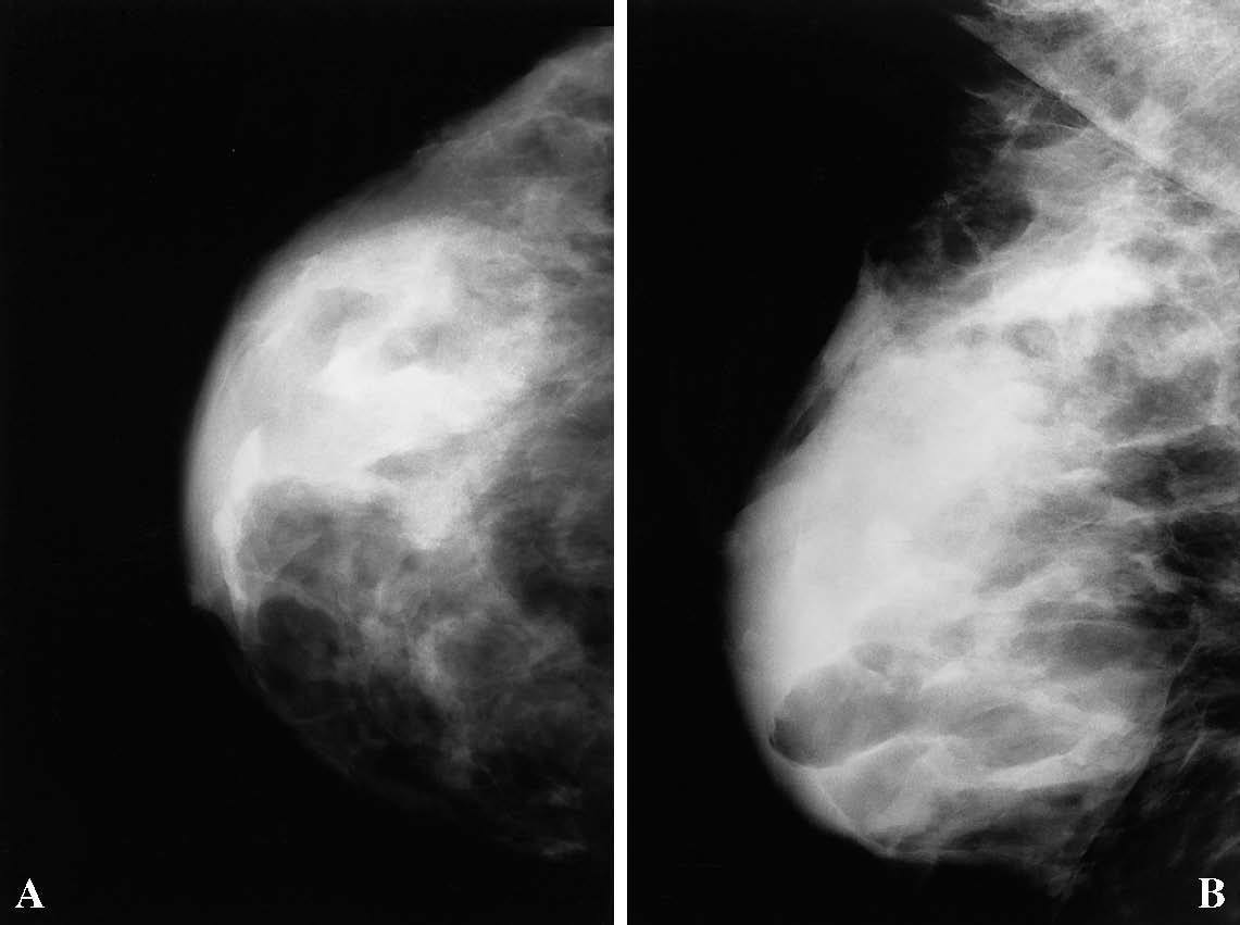 Linfoma de mama | Radiología