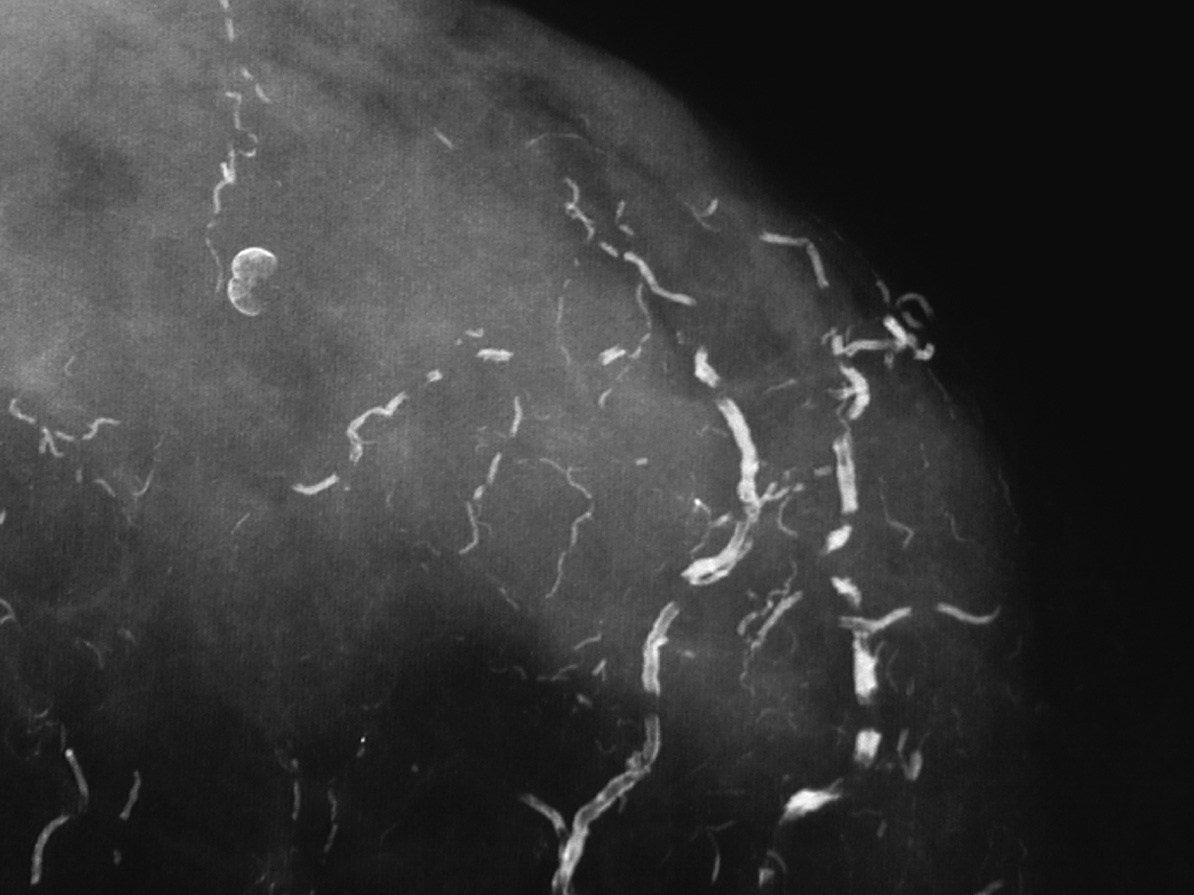 Calcificaciones mamarias en pacientes tratadas con hemodiálisis ...
