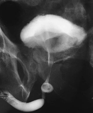 La Uretrografía Como Método Diagnóstico En La Patología Benigna Uretral
