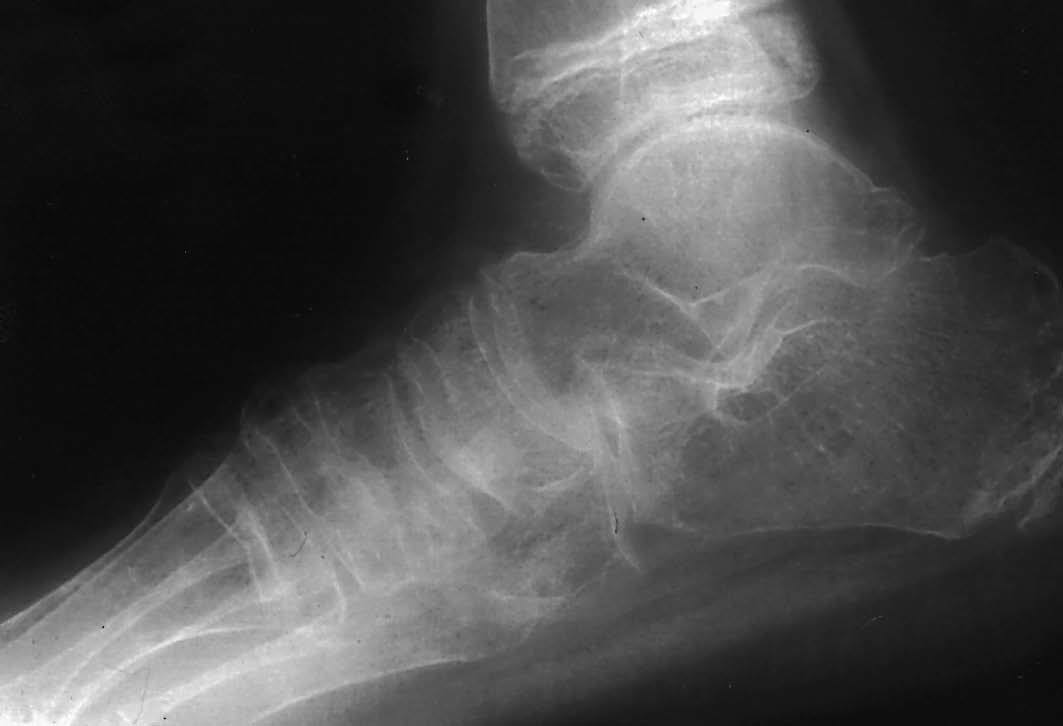 Osteoporosis idiopática juvenil: hallazgos radiológicos y revisión de ...