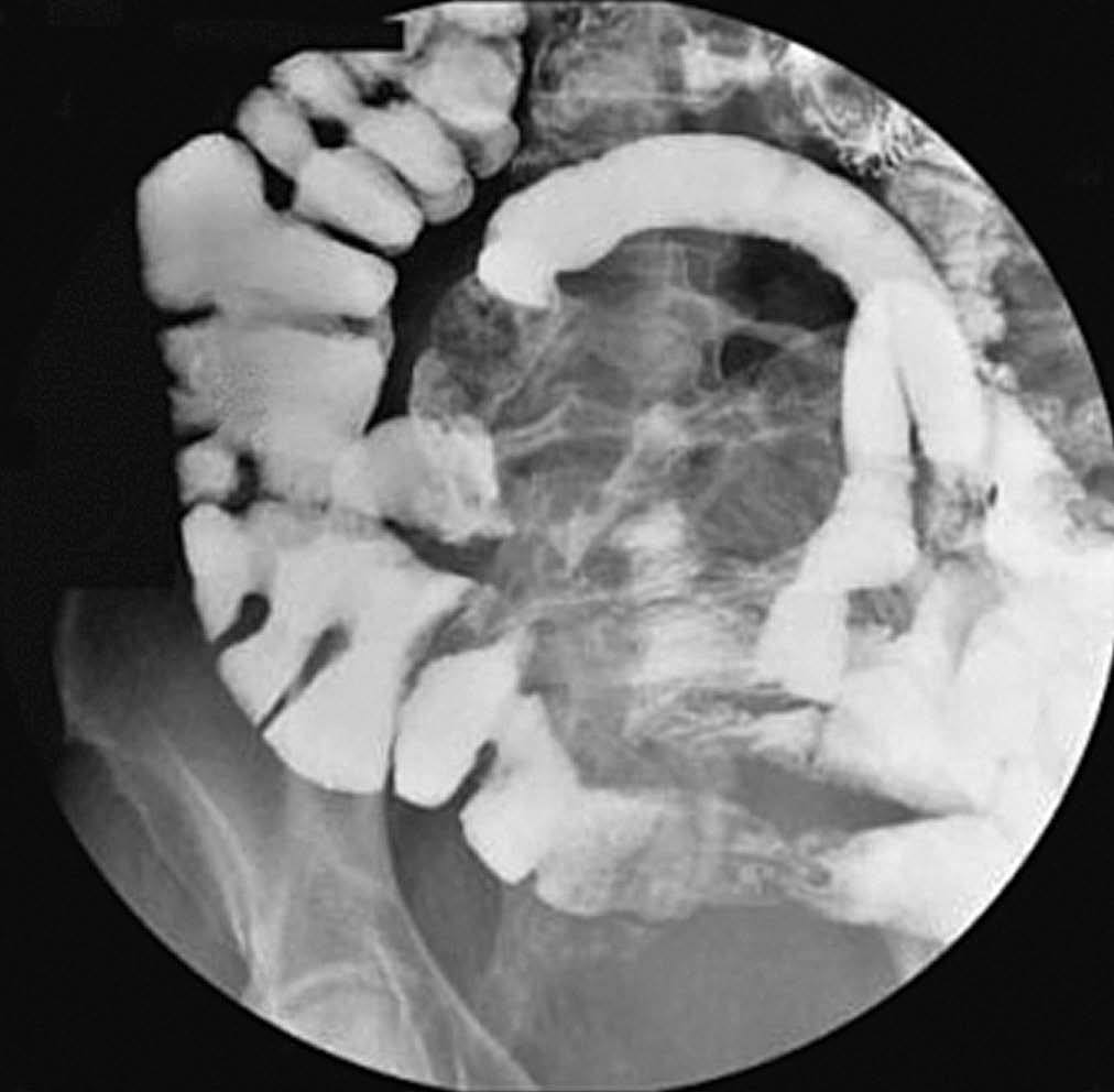 Estudio radiológico del intestino delgado | Radiología