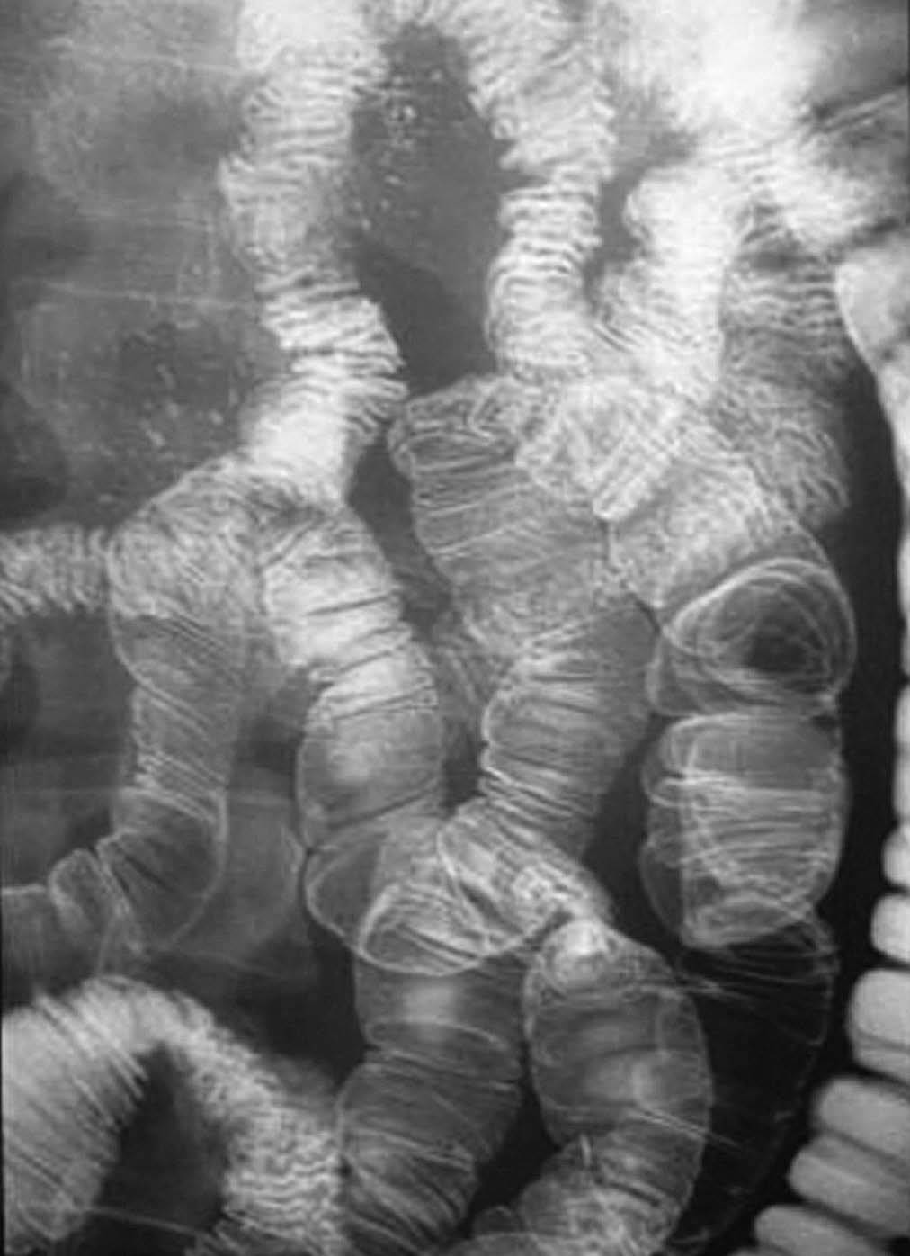 Estudio radiológico del intestino delgado | Radiología