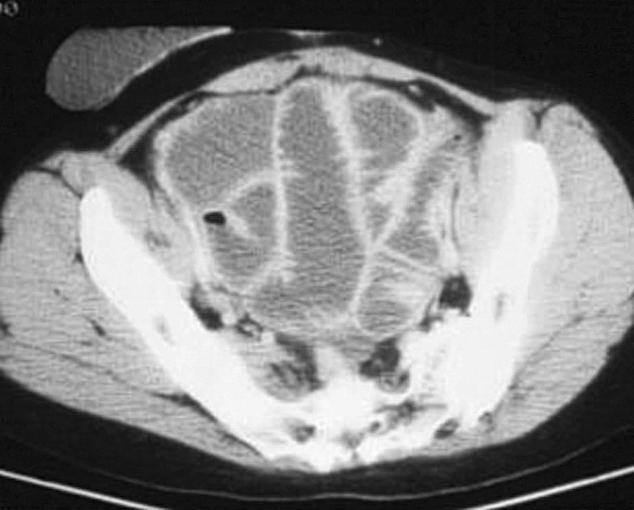 Estudio radiológico del intestino delgado | Radiología