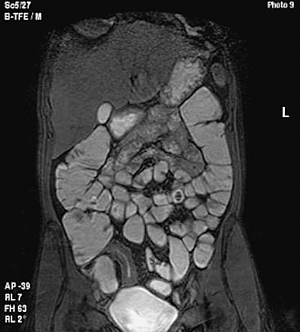 Estudio radiológico del intestino delgado | Radiología