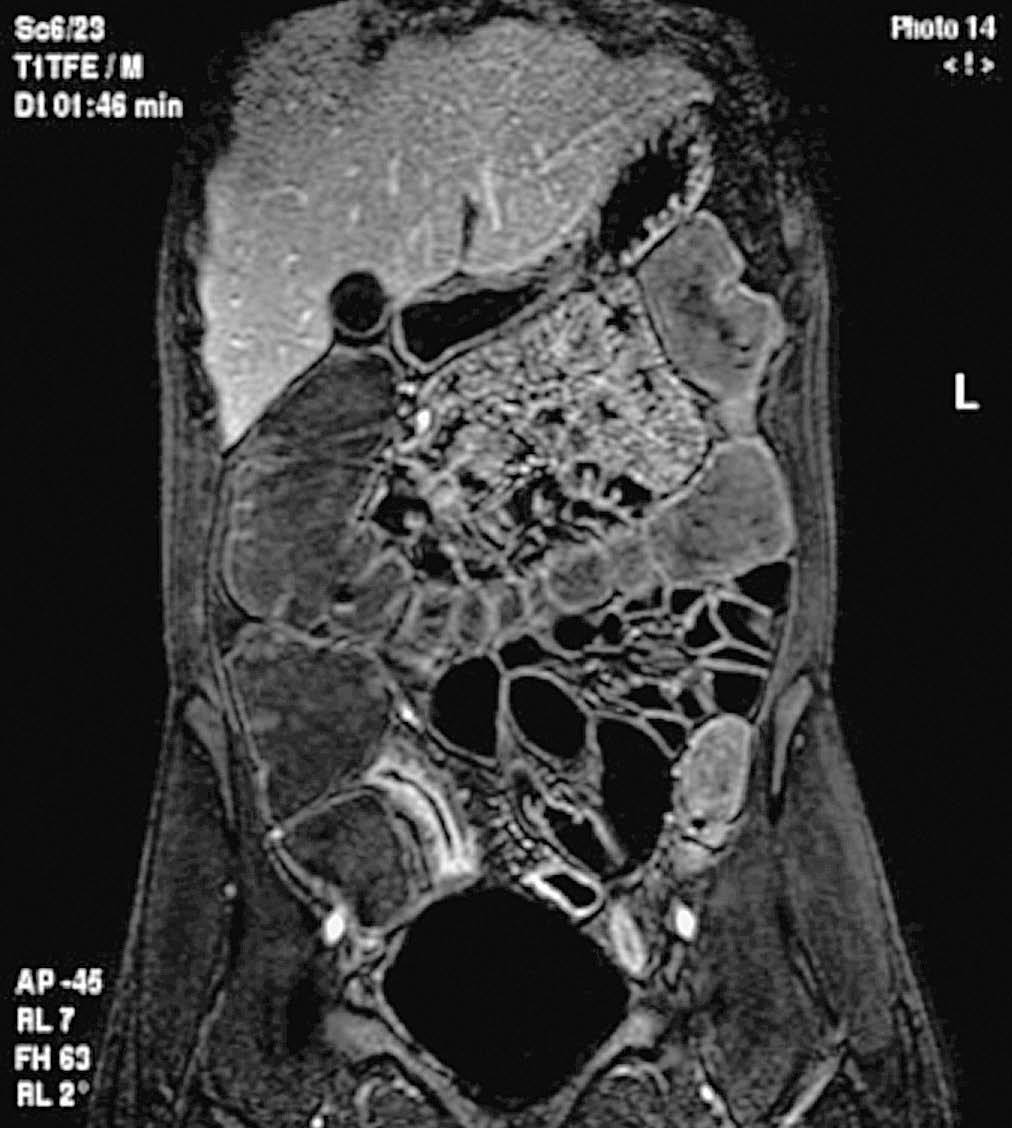 Estudio radiológico del intestino delgado | Radiología