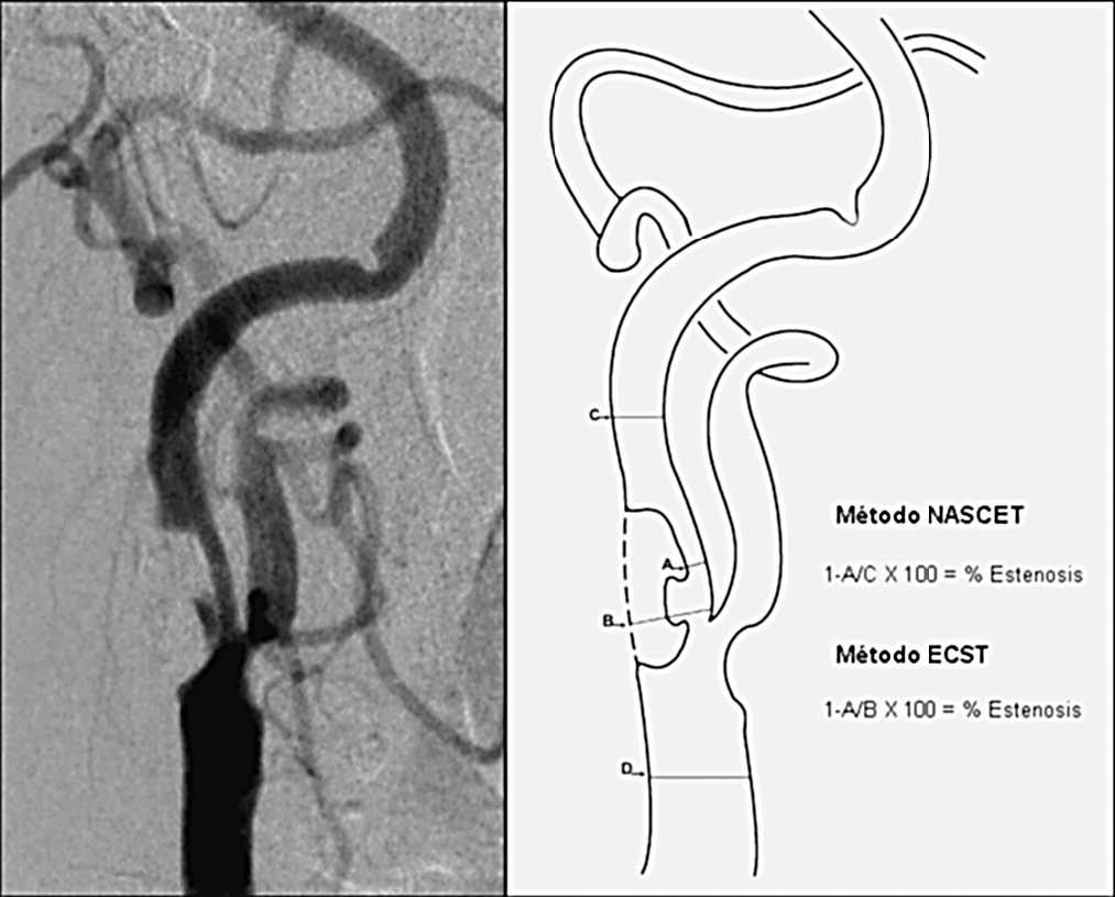 Estenosis carotídea: cómo se diagnostica y se trata adecuadamente ...