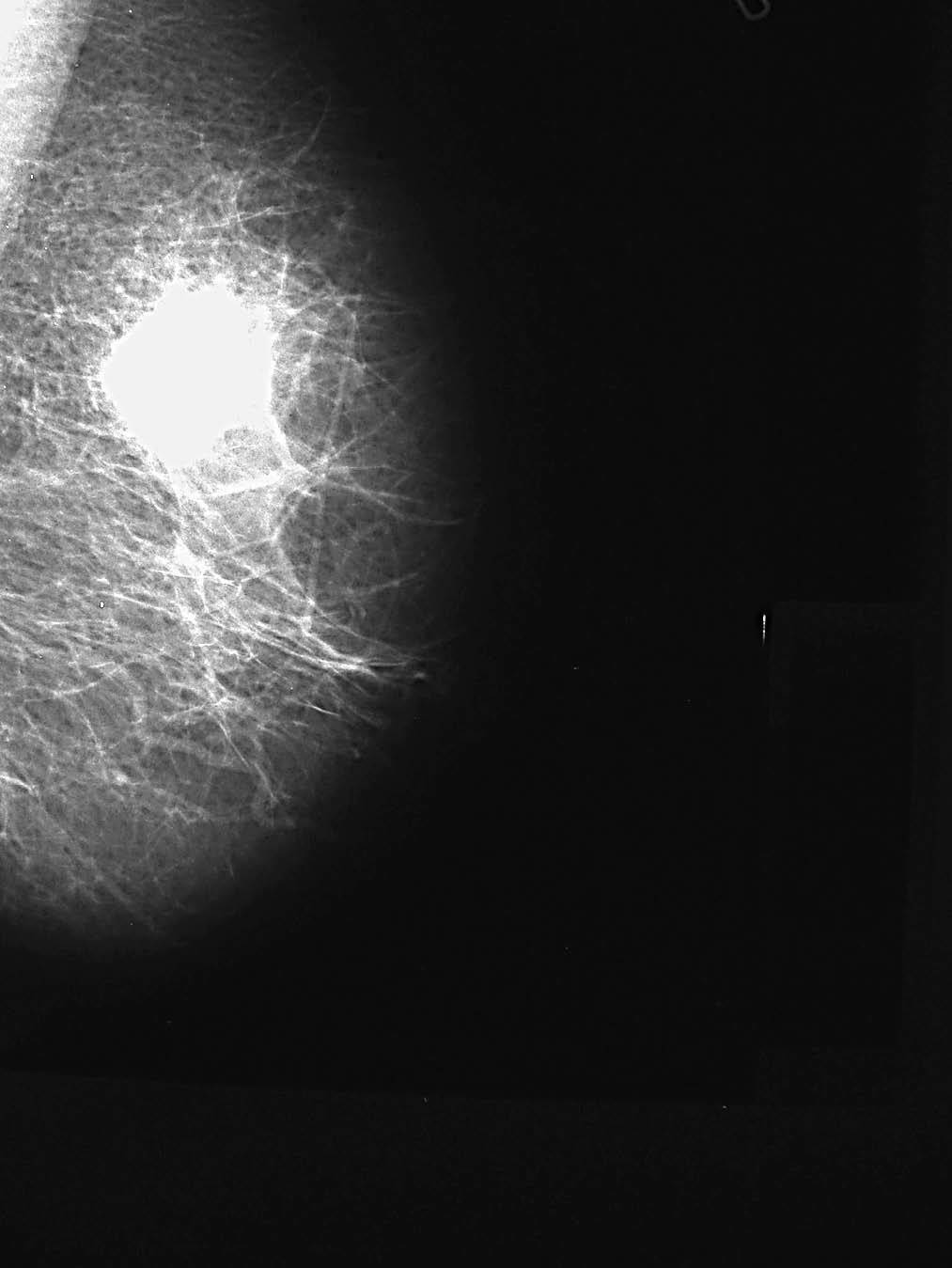 Carcinoma medular de mama: una lesión maligna que simula benignidad ...