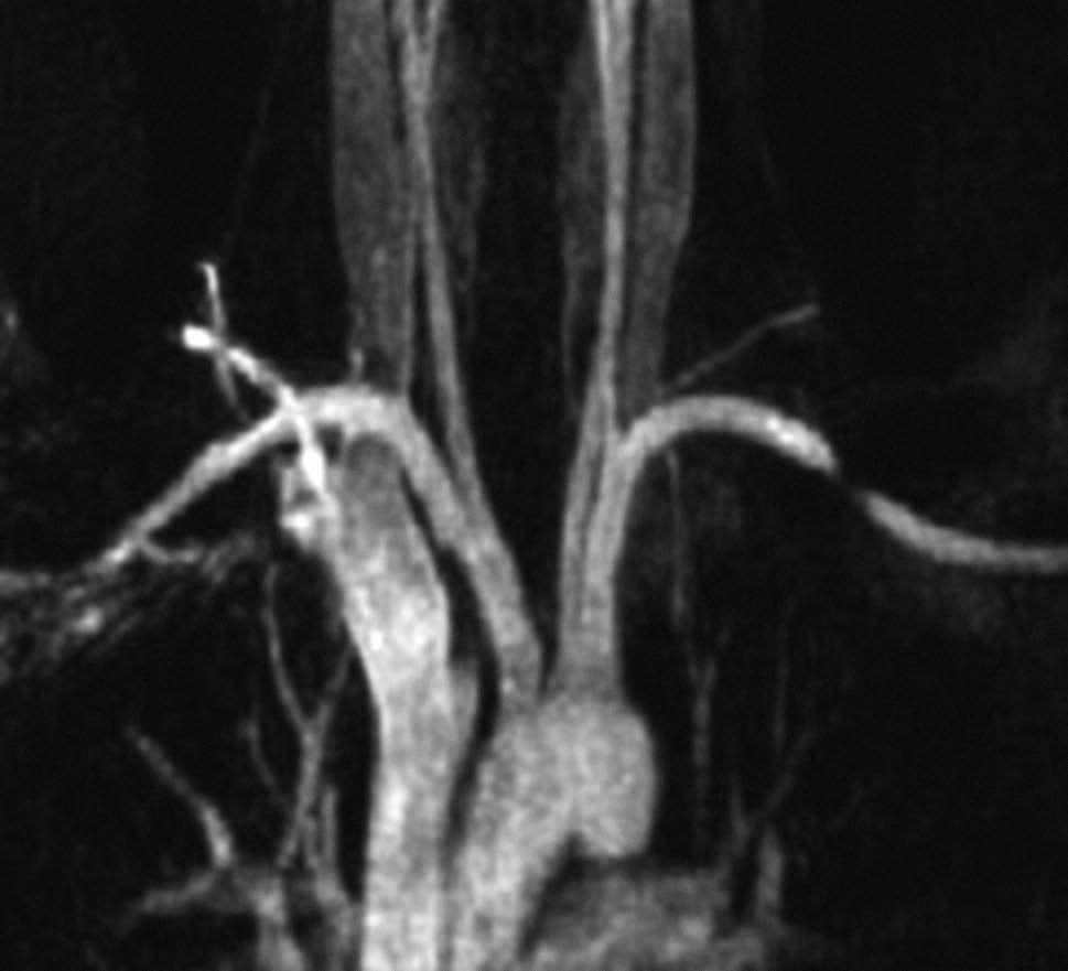 Diagnóstico por angiorresonancia magnética del síndrome del estrecho ...