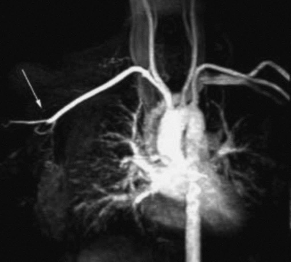 Diagnóstico por angiorresonancia magnética del síndrome del estrecho ...