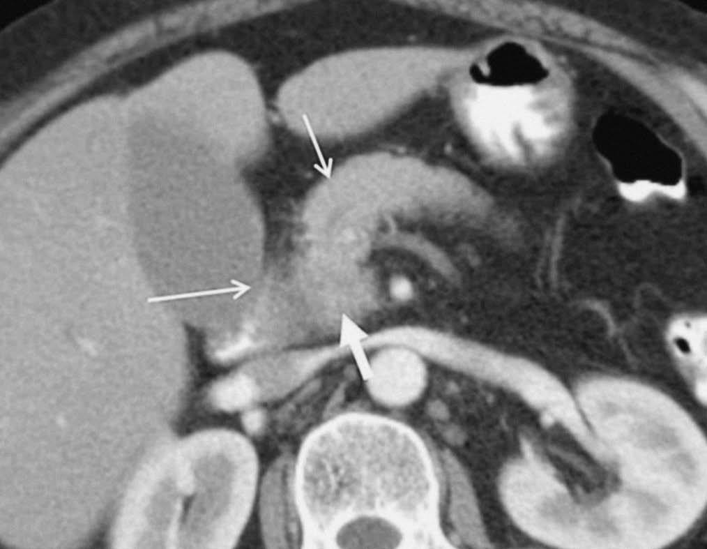Diagnóstico y estadificación del carcinoma de páncreas (I) | Radiología
