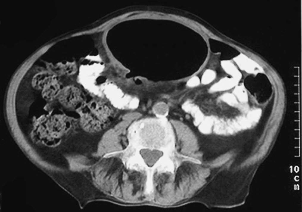Divertículo gigante de colon | Radiología