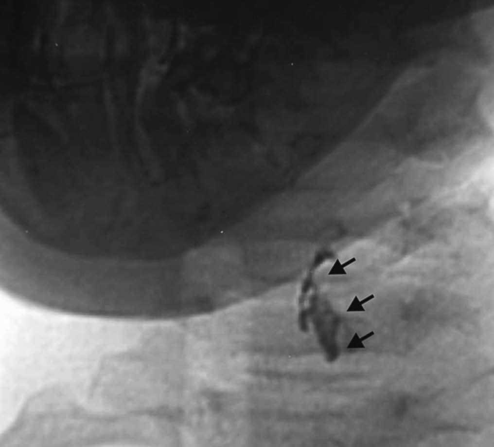 Estudio mediante técnicas de imagen de las fístulas del seno piriforme ...