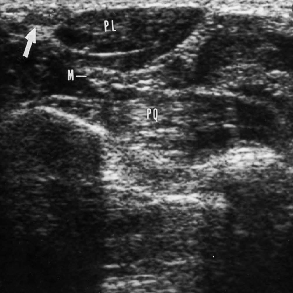 Claves para el diagnóstico ecográfico del músculo palmar largo ...