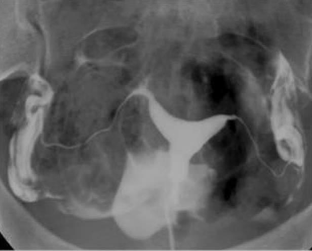 Histerosalpingografía: ¿cómo, cuándo, para qué? | Radiología