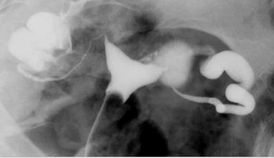 Histerosalpingografía: ¿cómo, cuándo, para qué? | Radiología