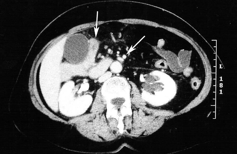 Síndrome de heterotaxia (poliesplenia) en un adulto | Radiología