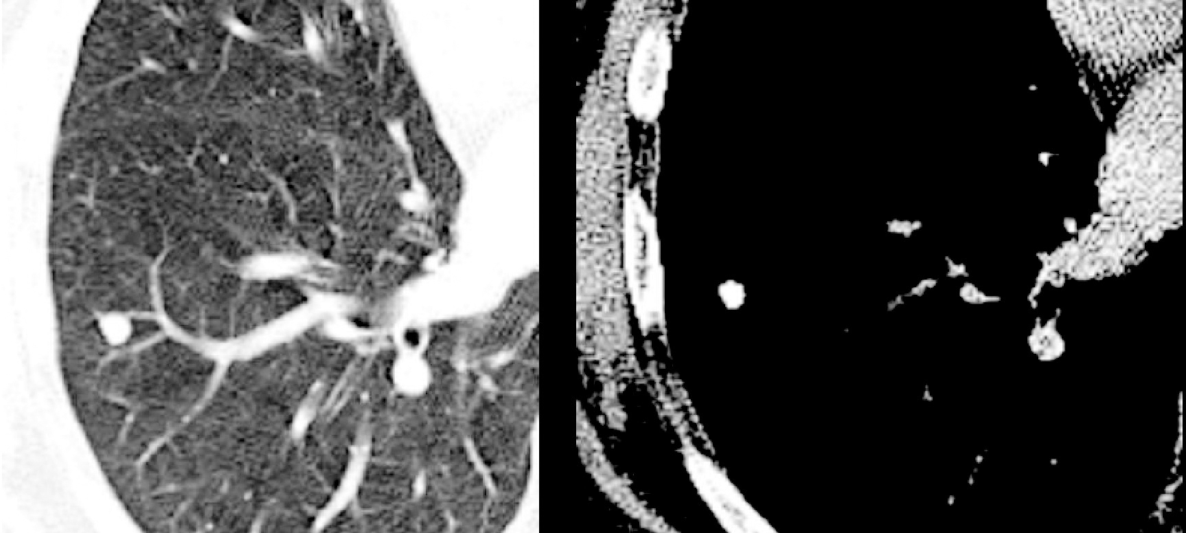 Detección y caracterización del nódulo pulmonar por tomografía ...