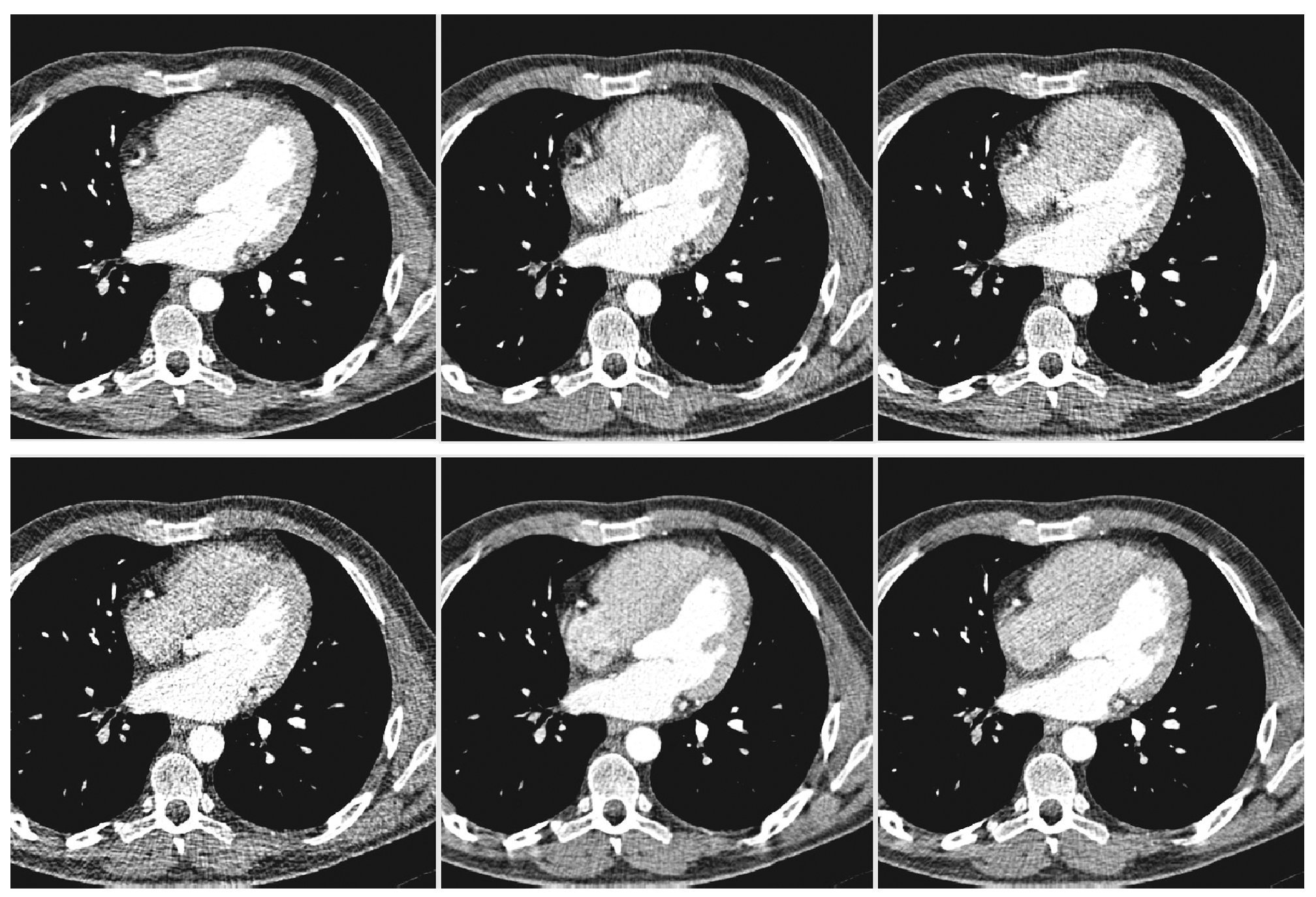 Consejos útiles para la realización de una TC-coronariografía | Radiología