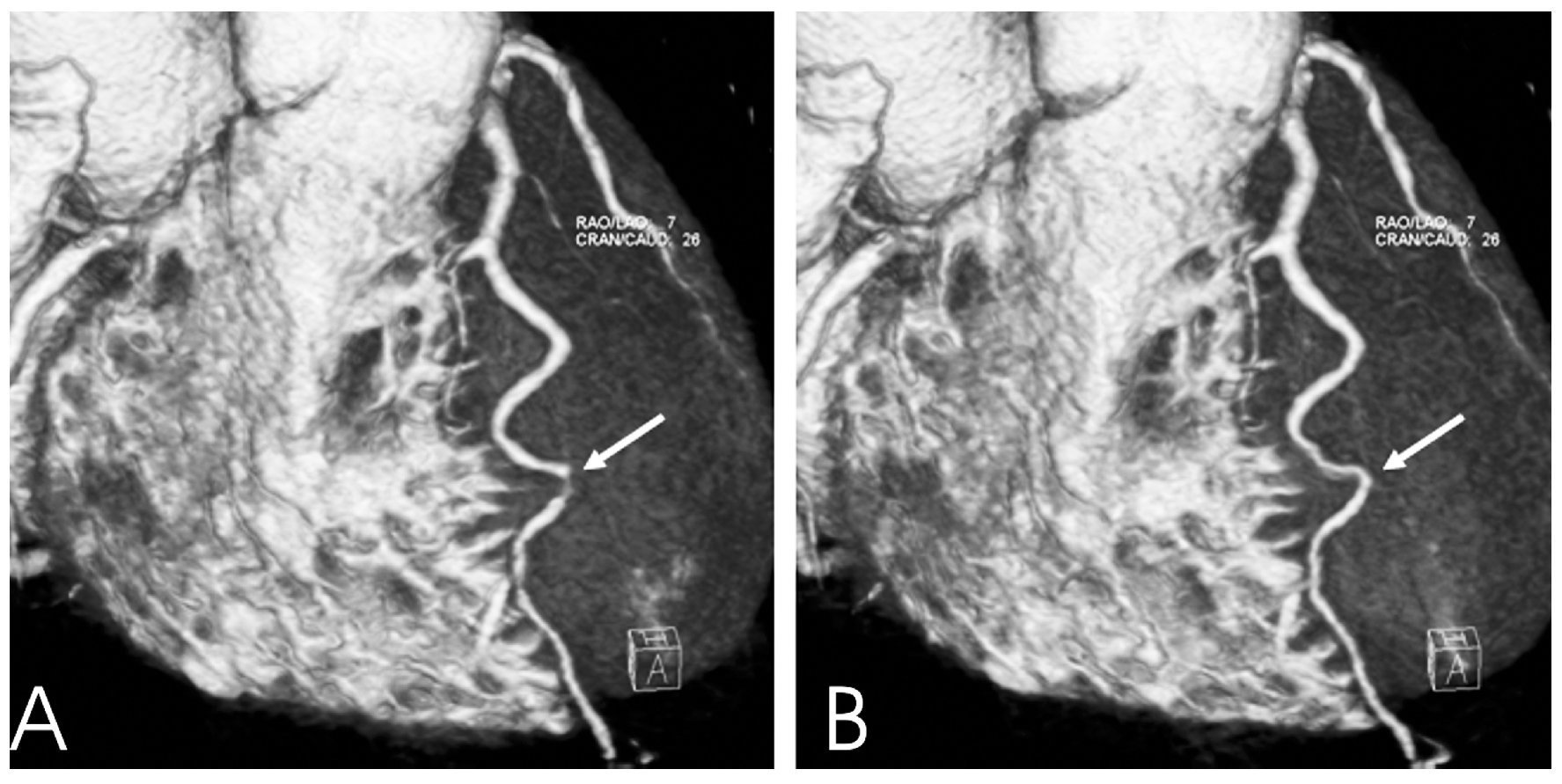 Consejos útiles para la realización de una TC-coronariografía | Radiología