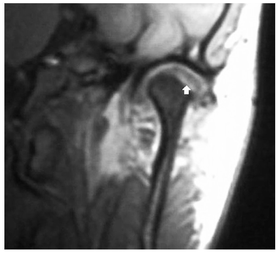 Resonancia magnética de la articulación temporomandibular | Radiología