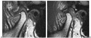 Resonancia magnética de la articulación temporomandibular | Radiología