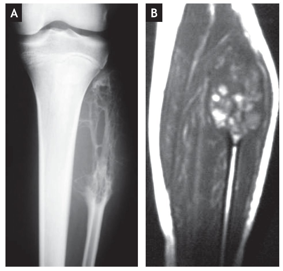 Manifestaciones radiológicas infrecuentes del sarcoma de Ewing en la ...