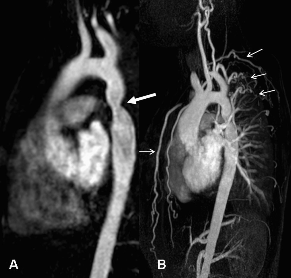Angiografía con contraste por resonancia magnética en las cardiopatías congénitas | Radiología