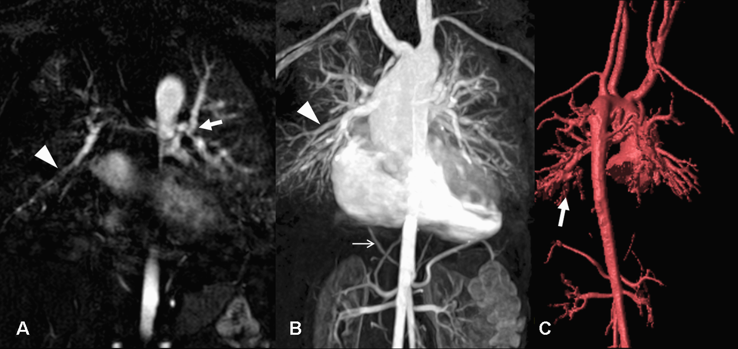 Angiografía con contraste por resonancia magnética en las cardiopatías ...