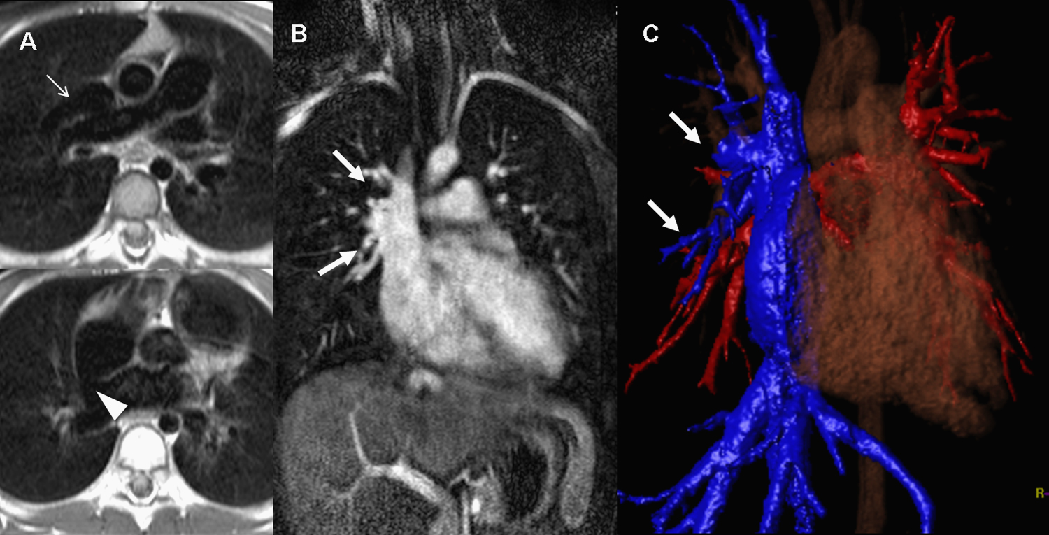 Angiografía con contraste por resonancia magnética en las cardiopatías congénitas | Radiología