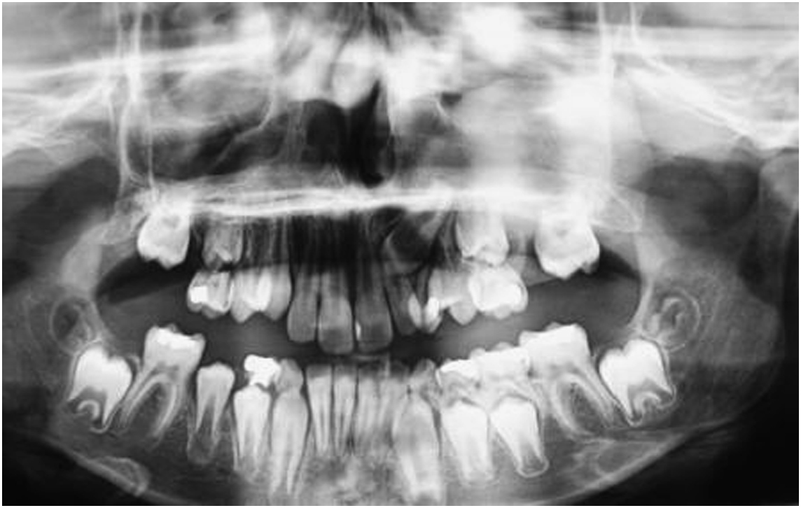 Solución del caso 6. Displasia fibrosa maxilar | Radiología