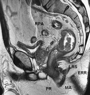 Estadificación del cáncer de recto | Radiología