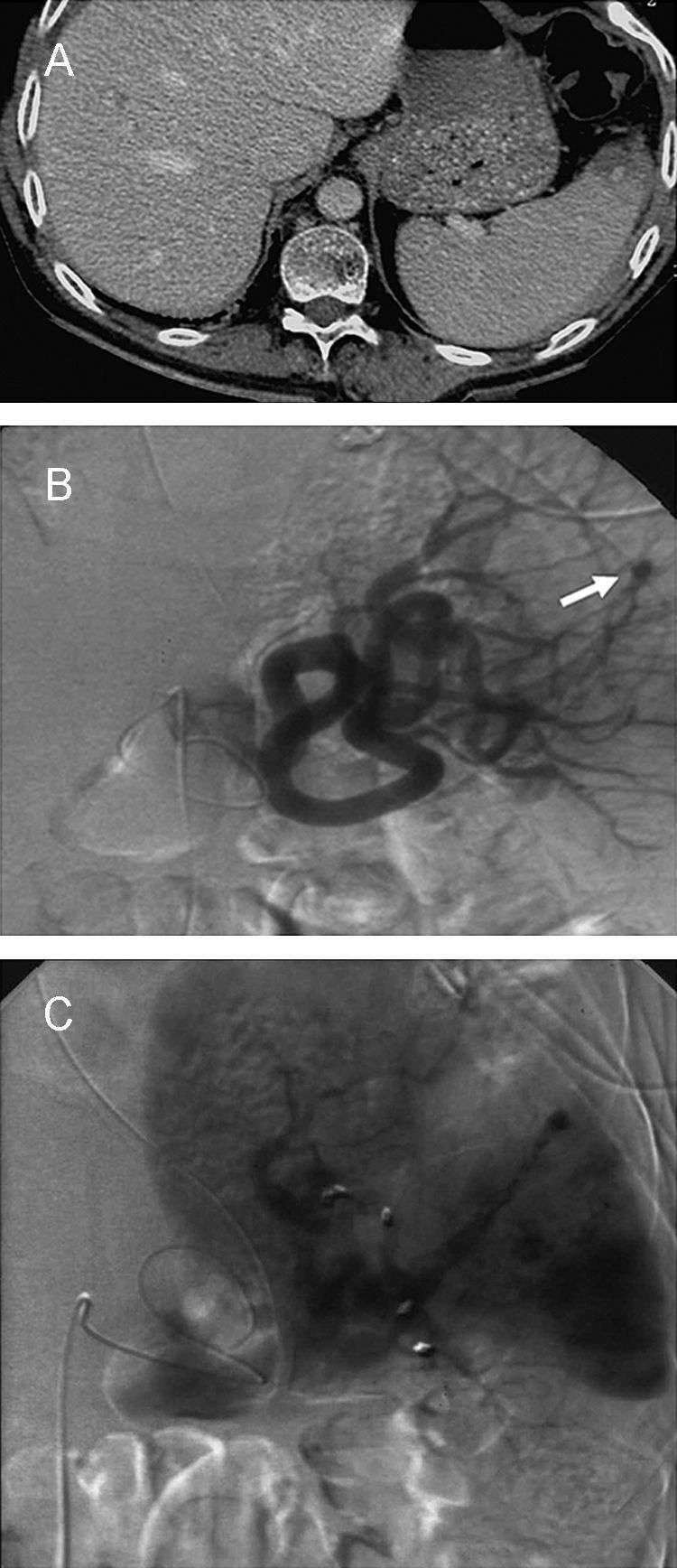 Manejo conservador de las lesiones esplénicas: experiencia en 136 ...