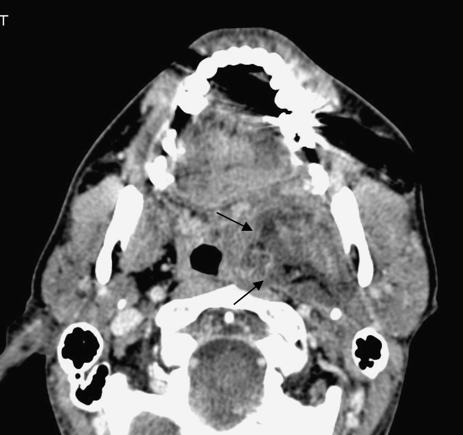 Fracturas y procesos infecciosos de la cara | Radiología