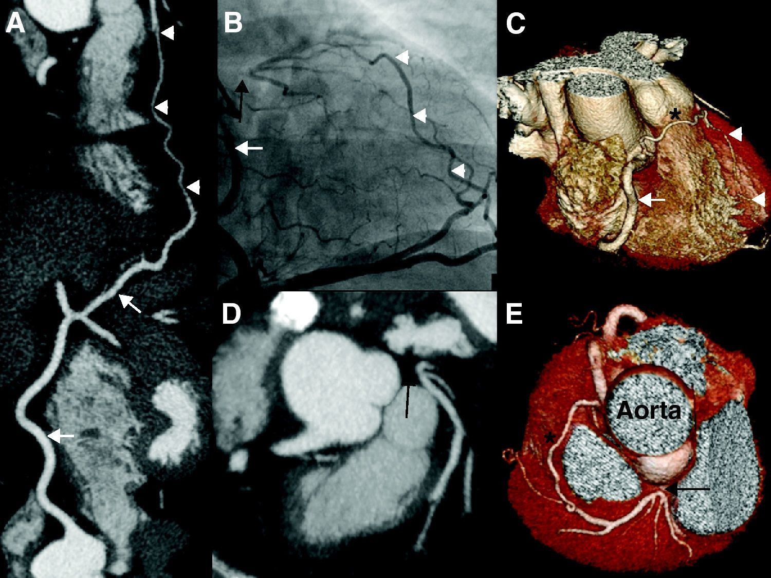 Diagnóstico de atresia de la arteria coronaria principal izquierda ...